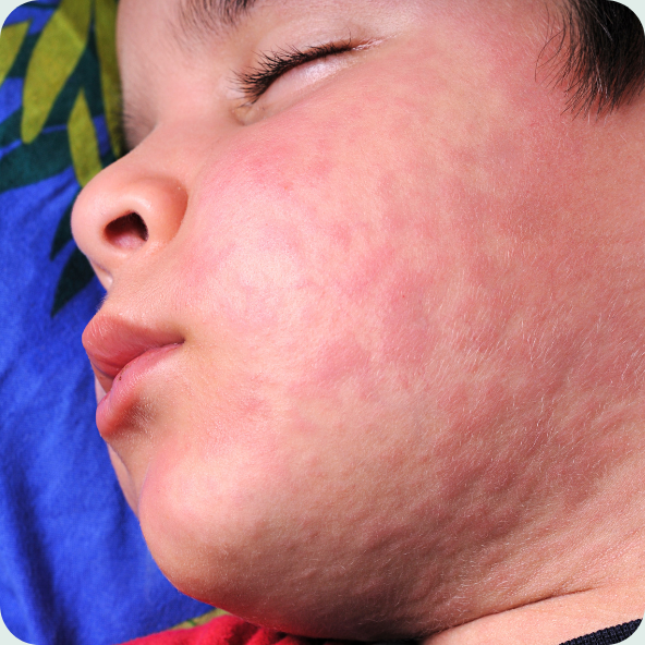 Pictures Of Hives On Kids Infoupdate Pictures Of Hives On Kids Infoupdate
